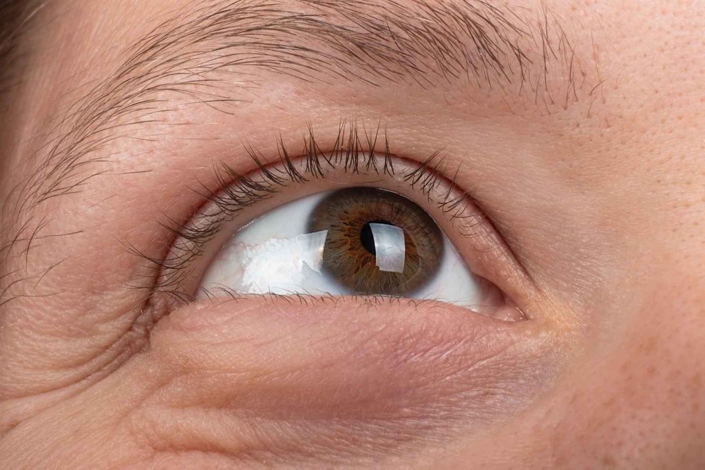 Understanding Keratoconus: Symptoms & Treatment | Horizon Eye