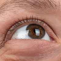 Understanding Keratoconus: Symptoms & Treatment | Horizon Eye